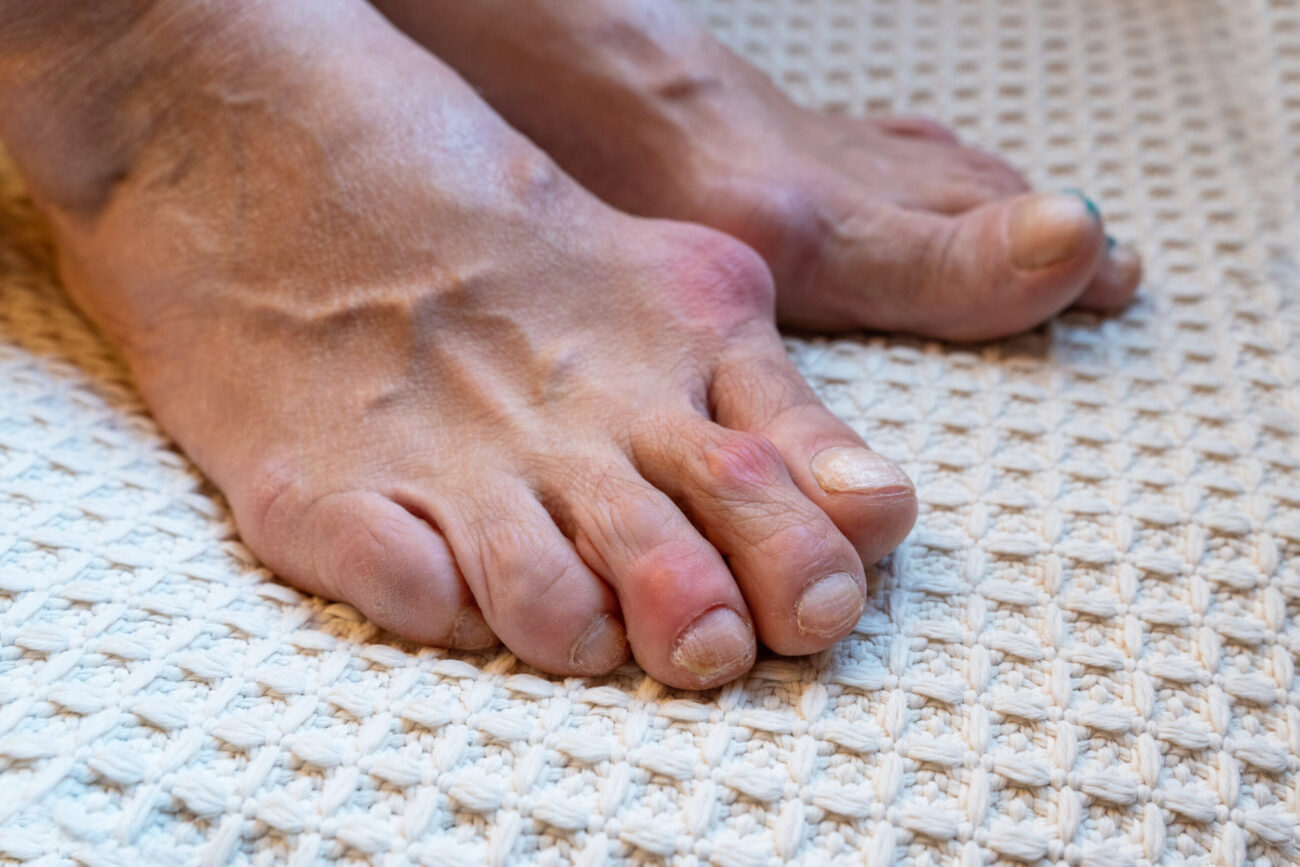 Rheumatoid Arthritis Soles Of Feet