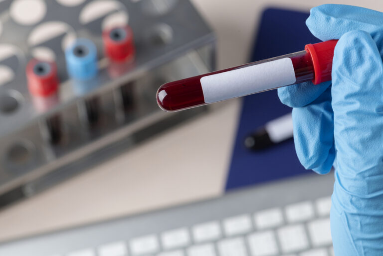What Is a Hematocrit Blood Test and Why Is It Important?